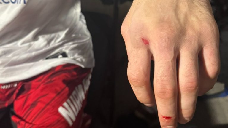Umar Nurmagomedov reveals broken hand suffered during UFC 311 defeat ...